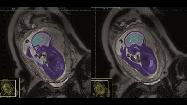MRI Scanning Techniques for Unborns | Action Medical Research